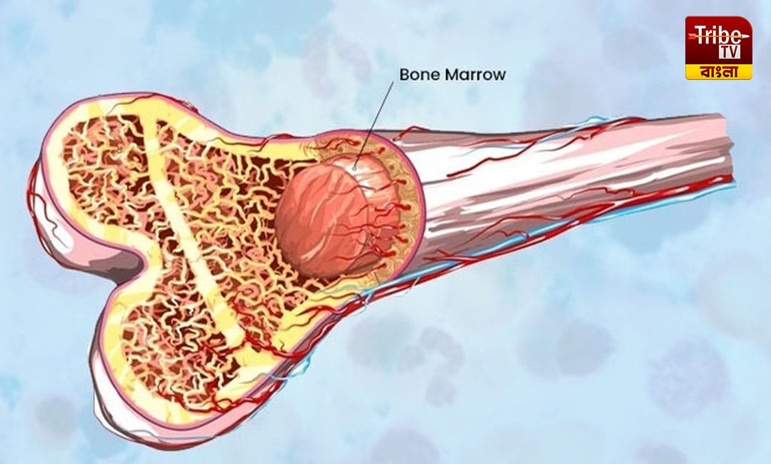 Bone marrow transplant: বোন ম্যারো ট্রান্সপ্ল্যান্টে সুস্থ শিশুরা ...